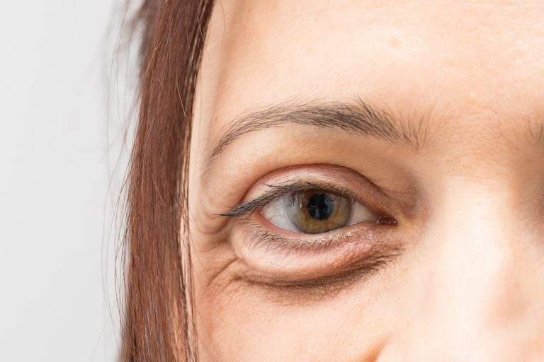 How to Get Rid of Bags Under Eyes When Smiling